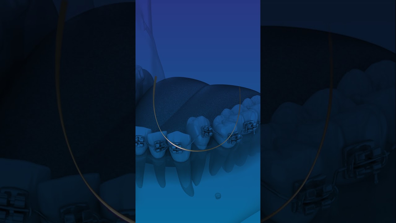 Braces Wire Types | Wire Sizes