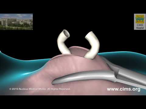 Vasectomy – CIMS Hospital