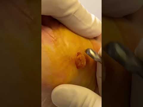 Watch this plantar wart removal surgery - a satisfying procedure for foot enthusiasts!