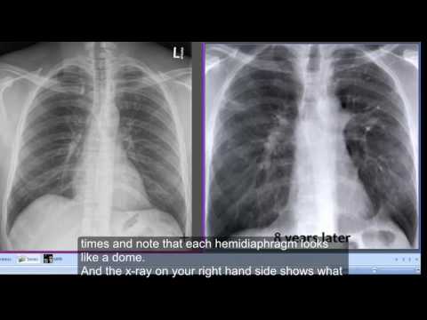 Chest x-ray, Tenting of hemidiaphragms