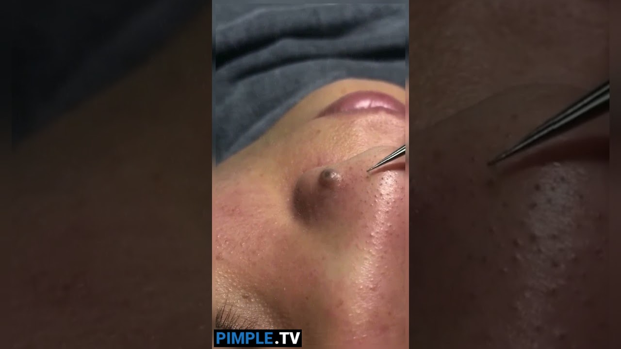 Extracting Large Blackheads Big Cystic Acne Blackheads&Whiteheads Removal Pimple Popping #143 #Short