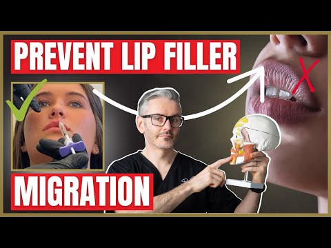 Prevent Lip Filler Migration | Causes, Prevention and How to Treat.