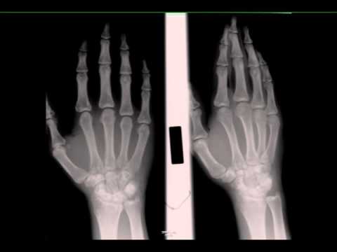 Osteopoikilosis