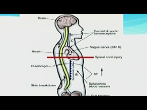 Autonomic Dysreflexia