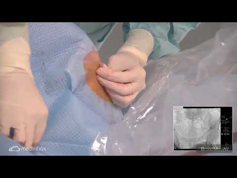 TAVI Using 29 mm Navitor Self-Expanding Valve