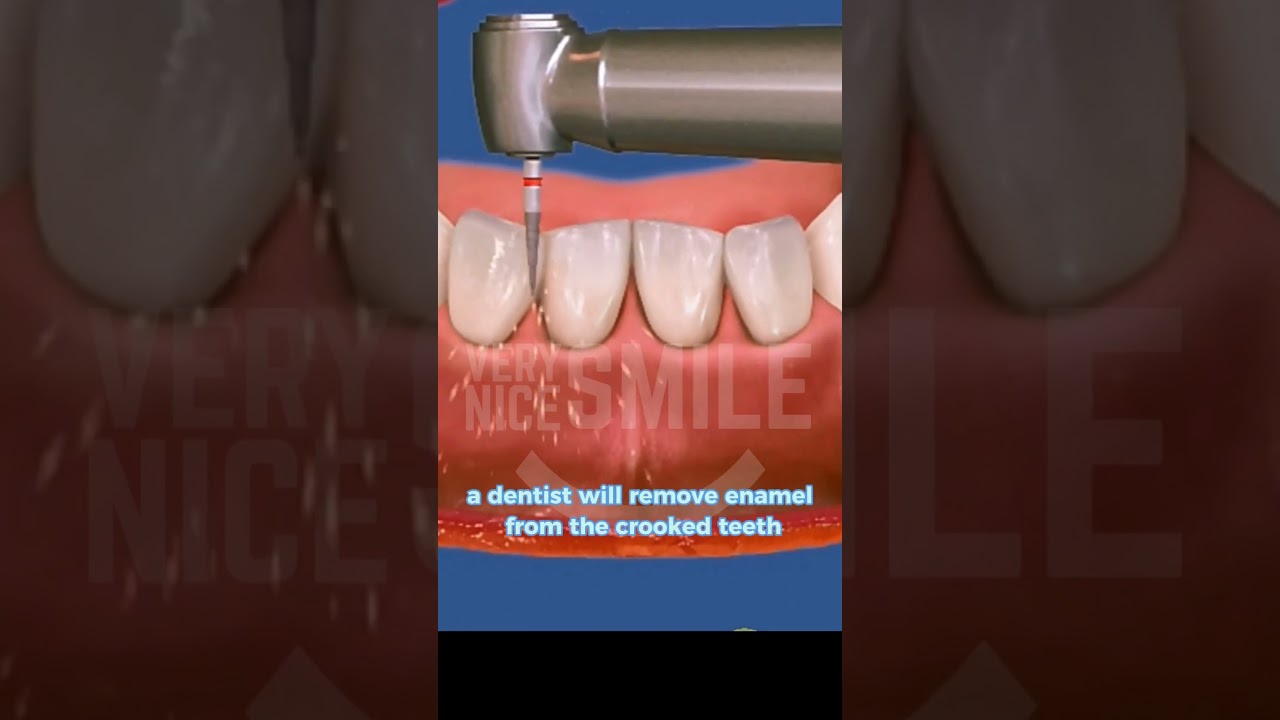 Enamelplasty to fix crooked teeth
