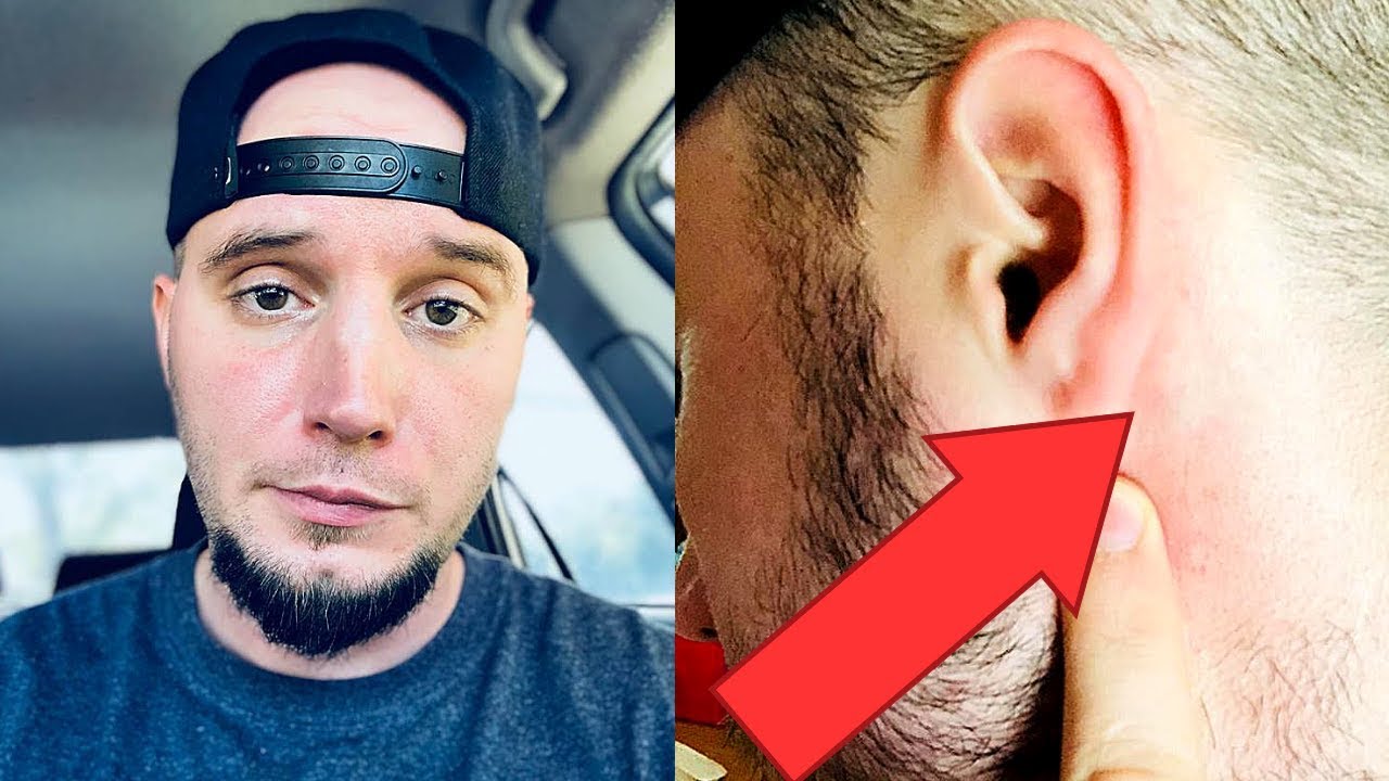 DISAPPOINTING UPDATE on the Lump Behind My Ear...
