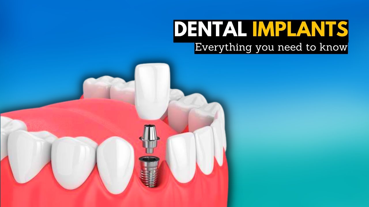 The Ultimate Guide to Dental Implants: Change Your Smile Forever!