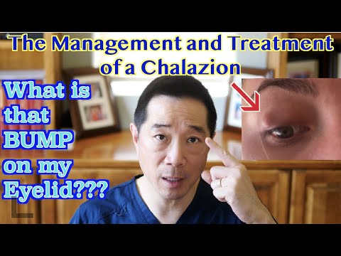 What is the bump on my eyelid? Treatment of a Chalazion.