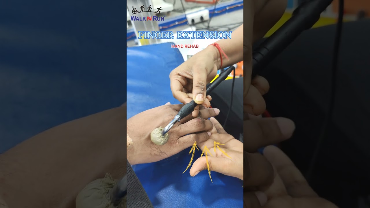 Physiotherapy for Hand Rehab - Finger Extension. #physiotherapy #fitness #physio #spinalcordinjury