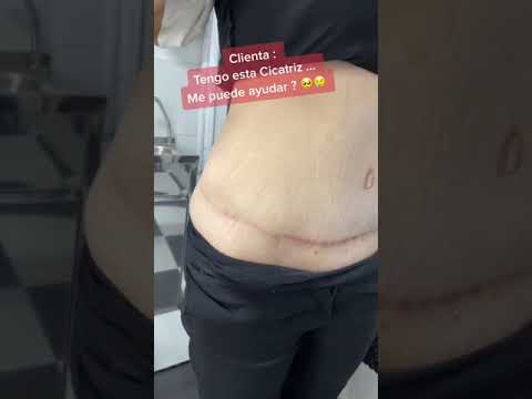 Tatuajes Para Tapar cicatrices En La Panza