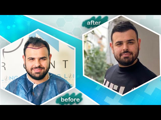 Hair Transplant Turkey | Long Hair Center | Long Hair Center