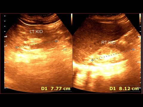 Chronic Kidney Disease | Renal Parenchymal Disease | Renal Failure | Normal Kidney