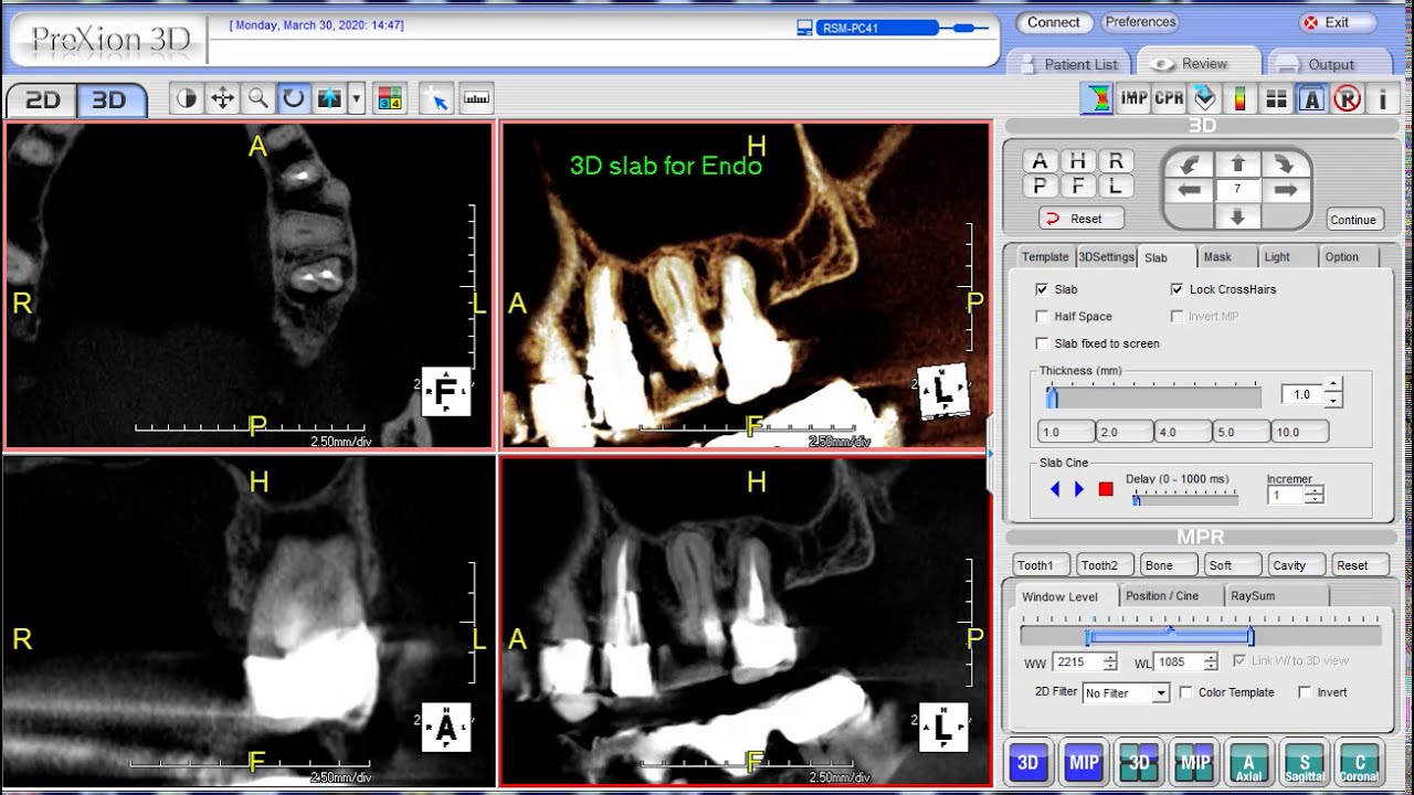 PreXion Training Tips: 3D Slab for Endo