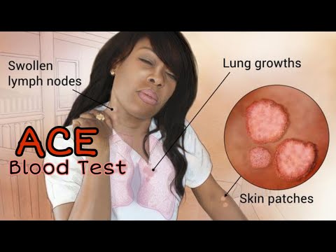 Angiotensin Converting Enzyme | ACE | Hindi, English Briefing