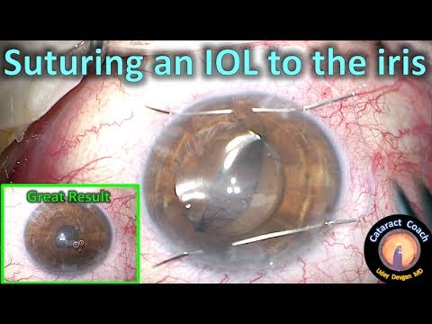 Cataract Surgery: how to suture the IOL to the iris for stability