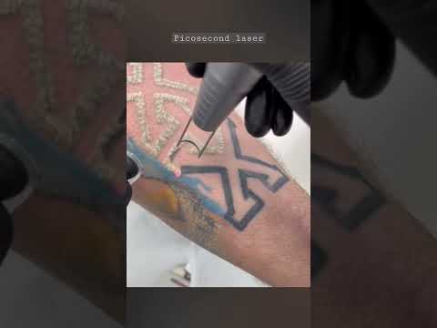 removing old tattoos with picosecond laser💀