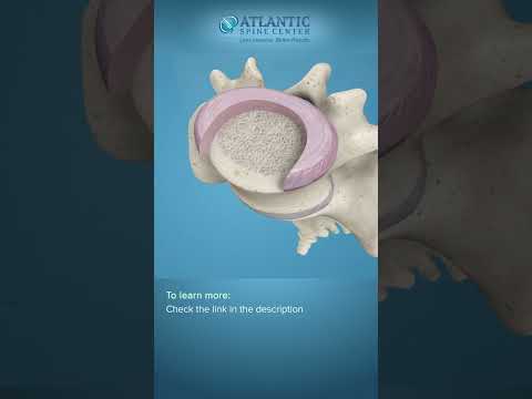What is Anterior Lumbar Interbody Fusion? | ALIF @Shorts