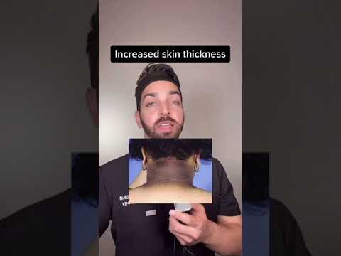 Darker Neck - DermDoctor Explains Acanthosis Nigricans #shorts