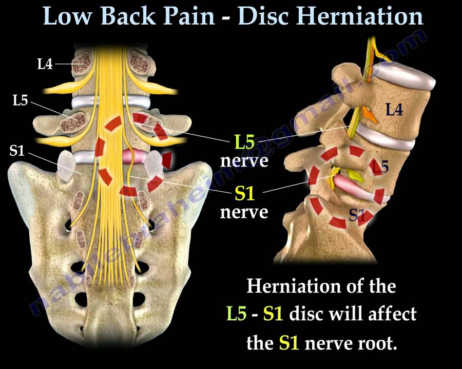 Low Back Pain -   Disc  Herniation ,Sciatica  - Everything You Need To Know - Dr. Nabil Ebraheim
