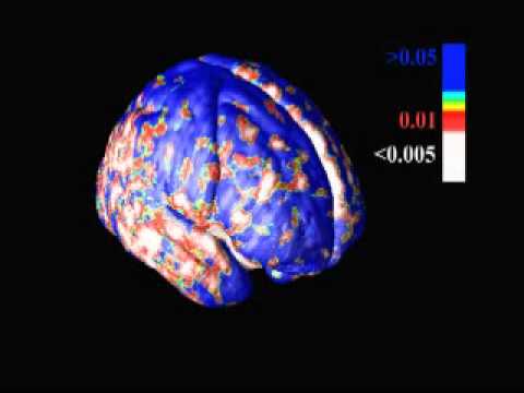 Progressive Cortical Thinning in Alzheimer's disease patients