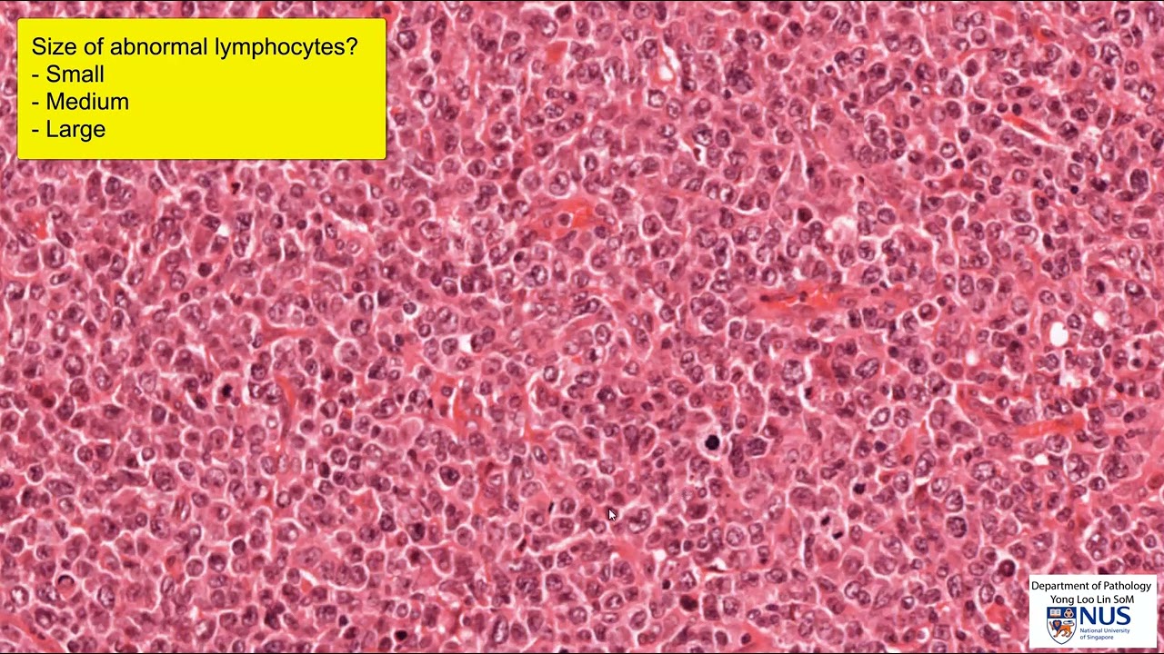 Lymph node: Large cell lymphoma microscopy - Talking Slide
