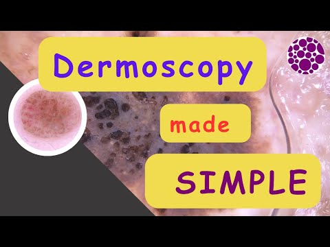 Dermoscopy made simple