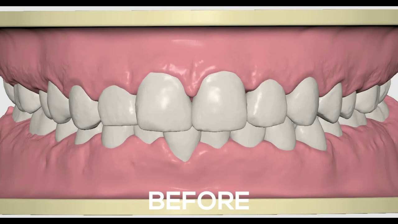 DEEPBITE | CLAER ALIGNER TREATMENT