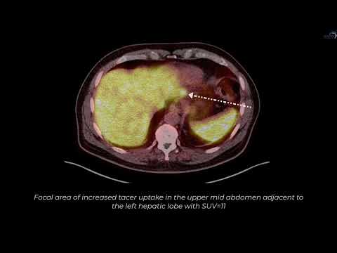 Ga-68 PET/CT Case 2