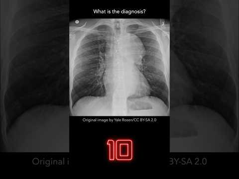 Chest X-ray Quiz 15 (explanation with overlays)