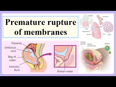 premature rupture of membranes