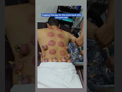 Cupping therapy for the entire back. #motivation #asmr #cuppingtherapy #sports