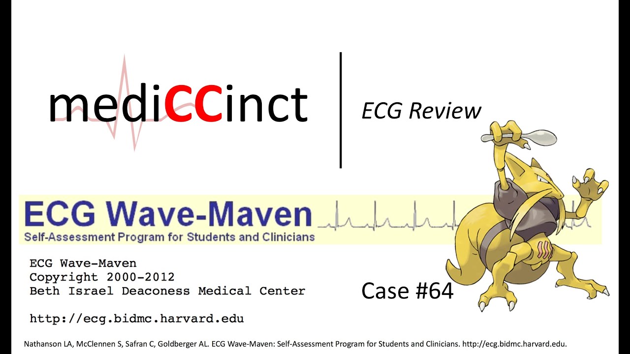 Atrial Flutter With 2:1 Conduction and LBBB (ECG Wave-Maven) Case #64