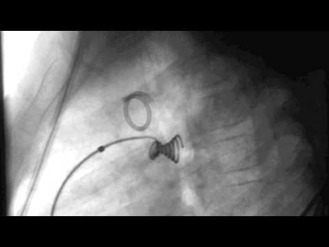 CENTRELE DE EXCELENTA ARES | Persistenta de Canal Arterial - Prof. Dr. Avraham Lorber