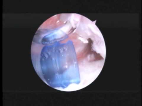 JC Posterior Bankart 42715