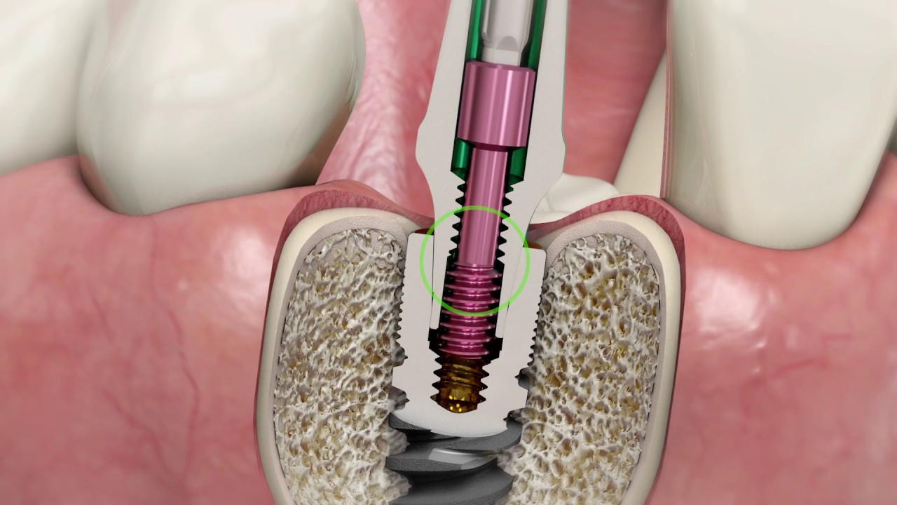 Implant Rootform. Easy superstructure removal.