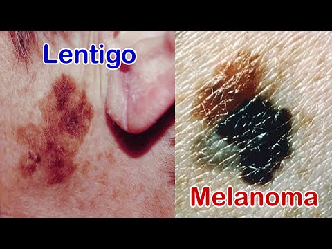 Old Age Spots (Lentigo) + Malignant Melanoma (Part 1 & 2): One Is Common and One Is Deadly!