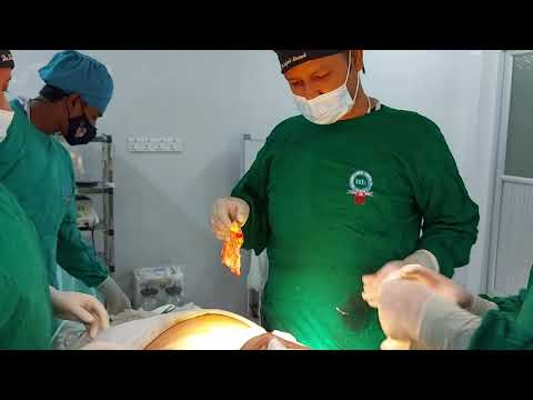 Gynecomastia surgery Bangladesh | Dr Iqbal Ahmed | Liposuction | 01314099922 | 01766935254