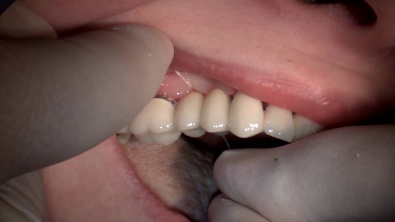 Dental patient education video: Bridge Floss homecare instructions for a patient