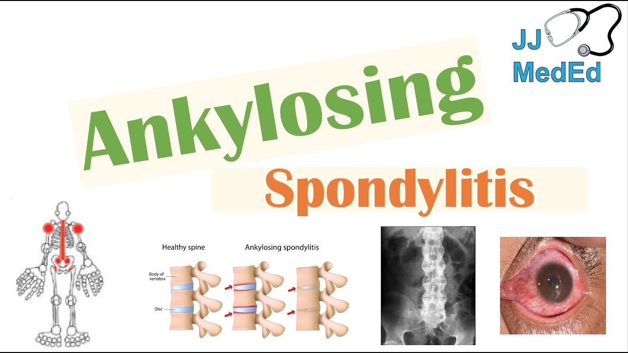 Ankylosing Spondylitis | HLA-B27, Pathophysiology, Signs & Symptoms, Diagnosis, Treatment