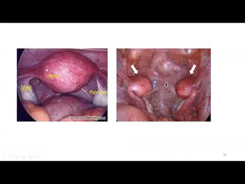 2 Primary amenorrhea