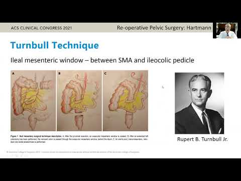 Closing Colostomy in Re Operative Pelvis in Patients Who Have Had a Hartmann's Procedure