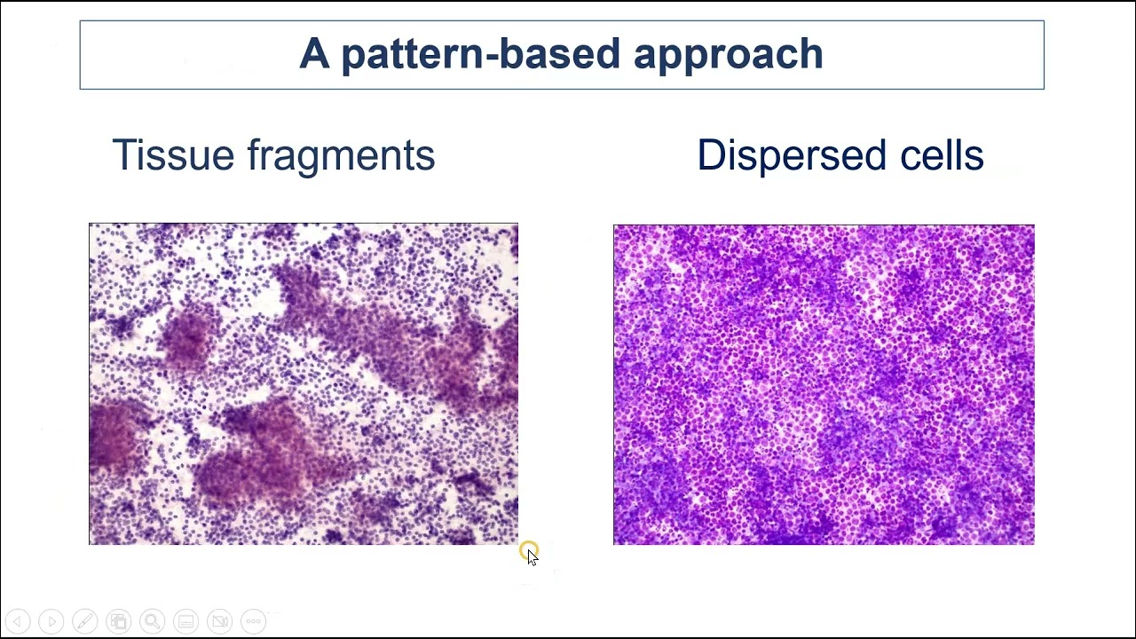 Lymph Node Cytology: Approach to Lymph Node Cytology (Updated 2026)