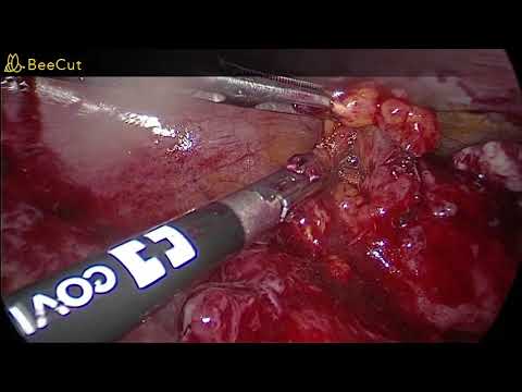 INTERVAL appendectomy