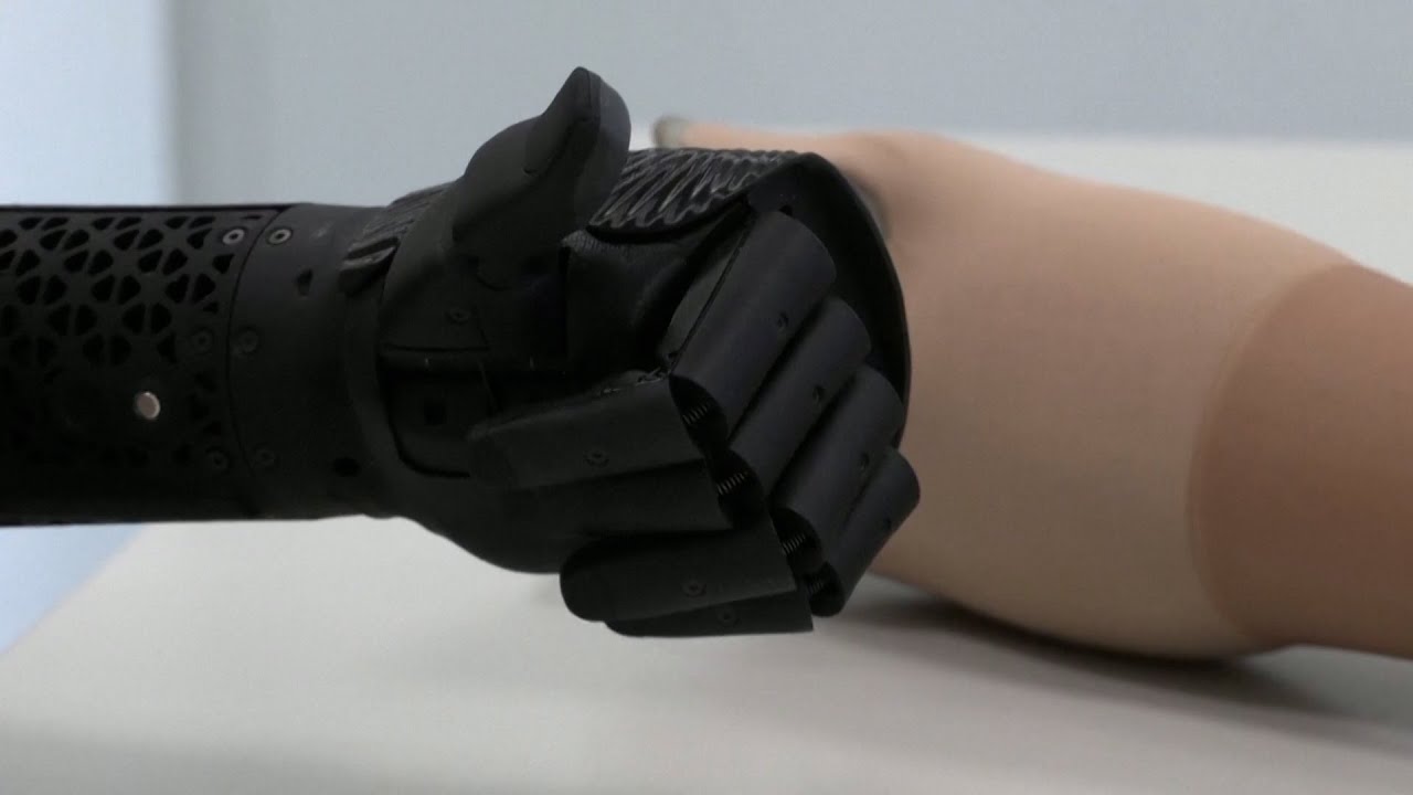 German woman has life transformed by new bionic arm