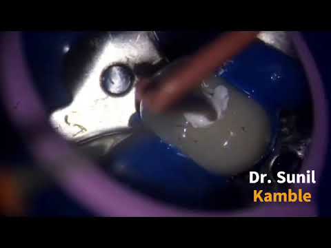 Root Canal Sealer at Best Price in India