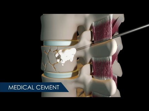 Kyphoplasty CPC