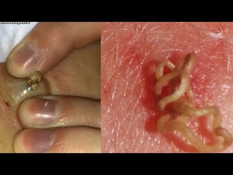 Greatest Pimple Pops & Biggest Blackheads of Reddit