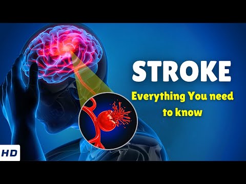 What is a Stroke? Causes, Types, Signs and Symptoms, Diagnosis & Treatment