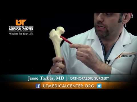 Hip Fractures - Dr. Torber